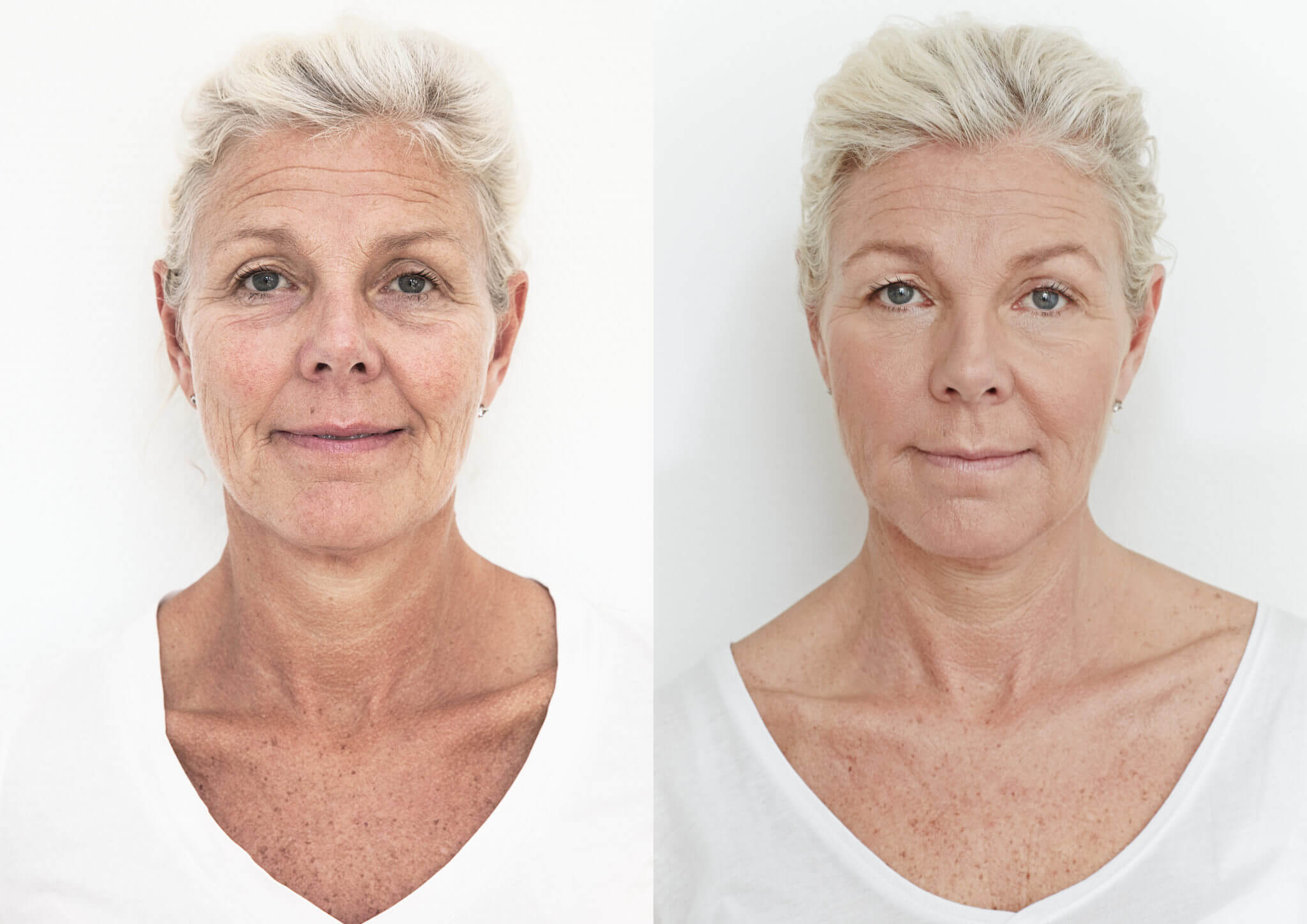 De bedste behandlinger til moden hud - nage.dk